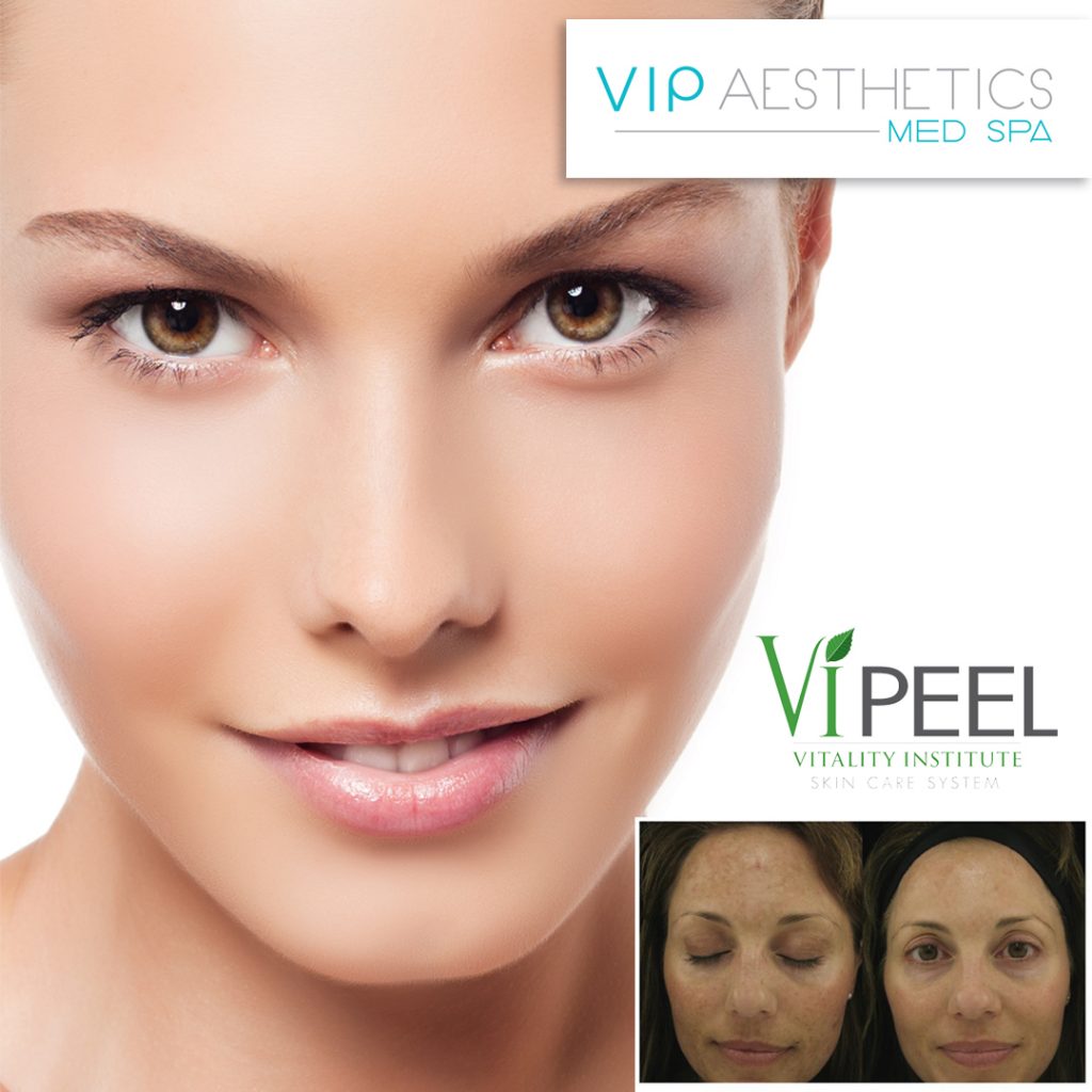 Vi Peel, a great choice for your skin | VIP Aesthetics - Fort ...