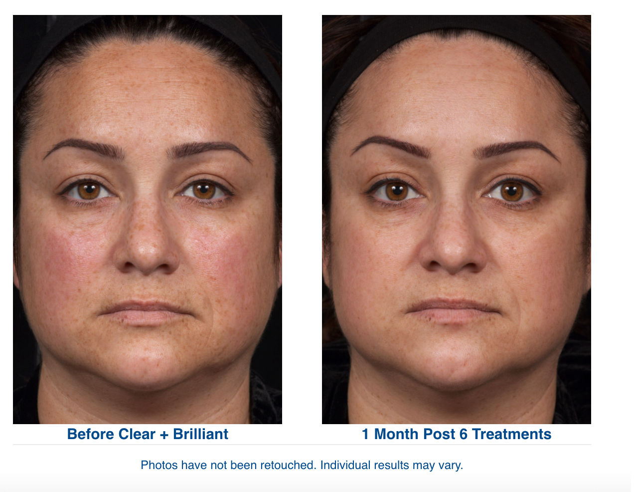 CLEAR + BRILLIANT | VIP Aesthetics - Fort Lauderdale, FL