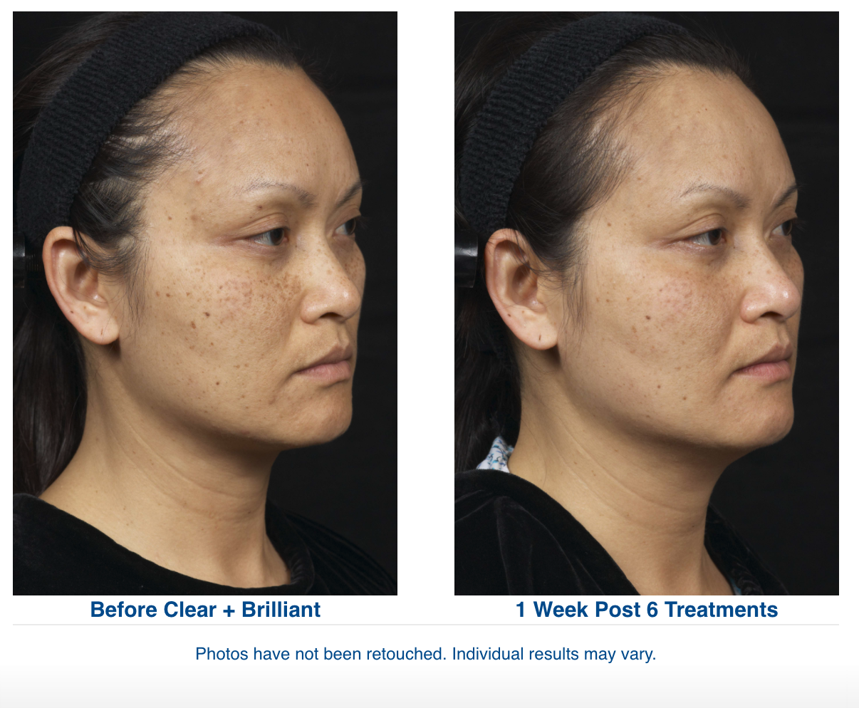 CLEAR + BRILLIANT | VIP Aesthetics - Fort Lauderdale, FL