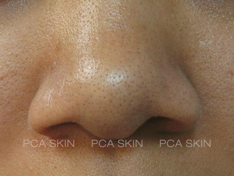 PCA Peels | VIP Aesthetics - Fort Lauderdale, FL